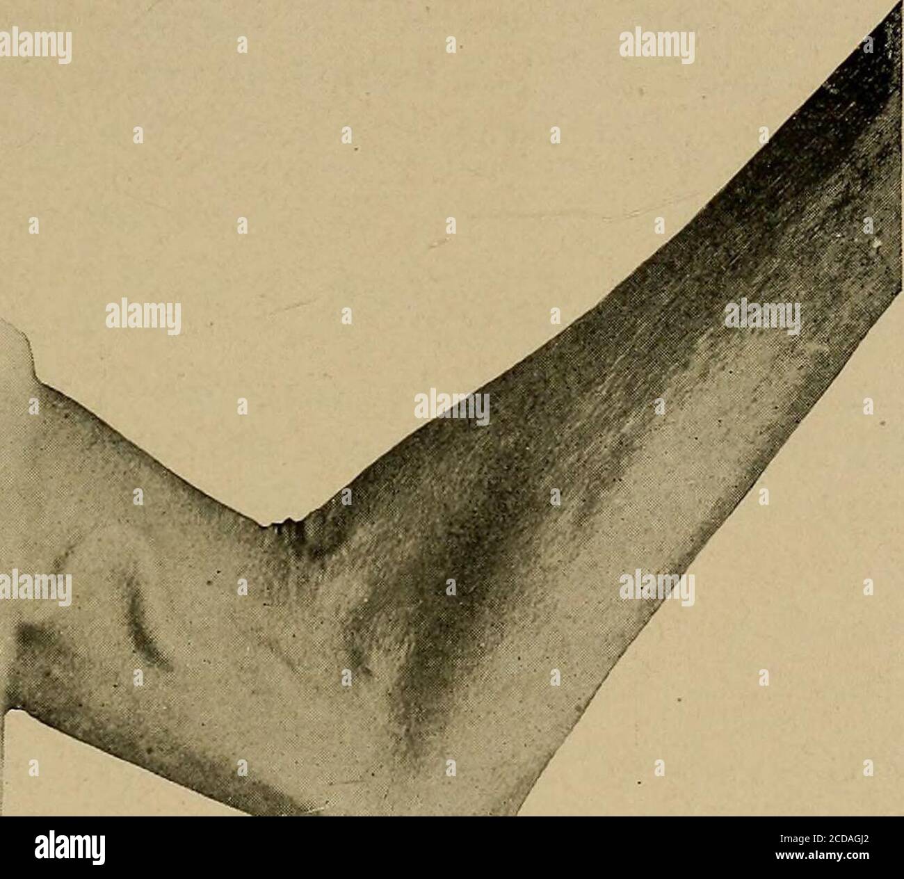 . Physical diagnosis . * (b) Arterial Phenomena. 1. In thin or nervous ...