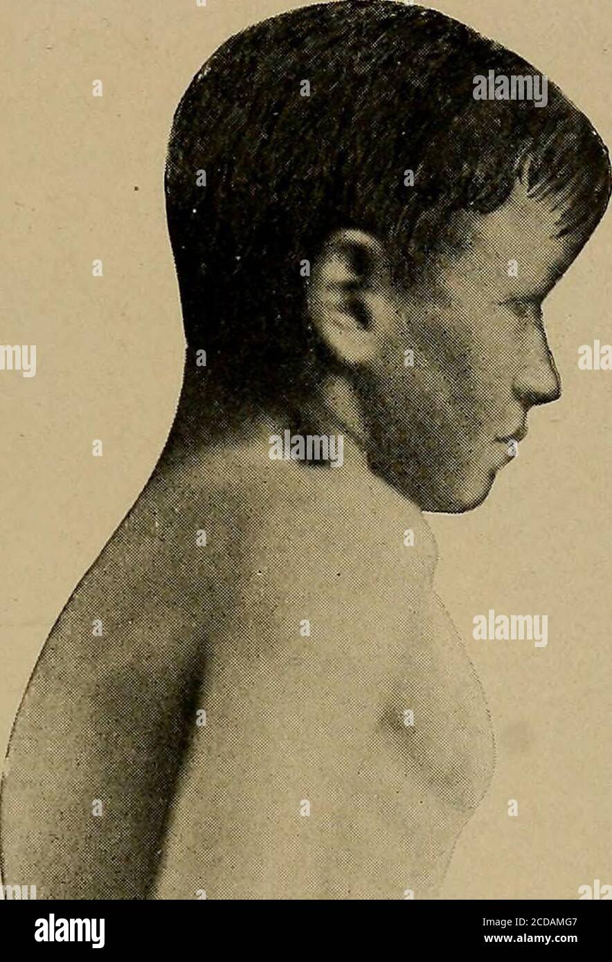 . Physical diagnosis . Fig. 67.—The Paralytic Thorax. Fig. 68.—Barrel ...