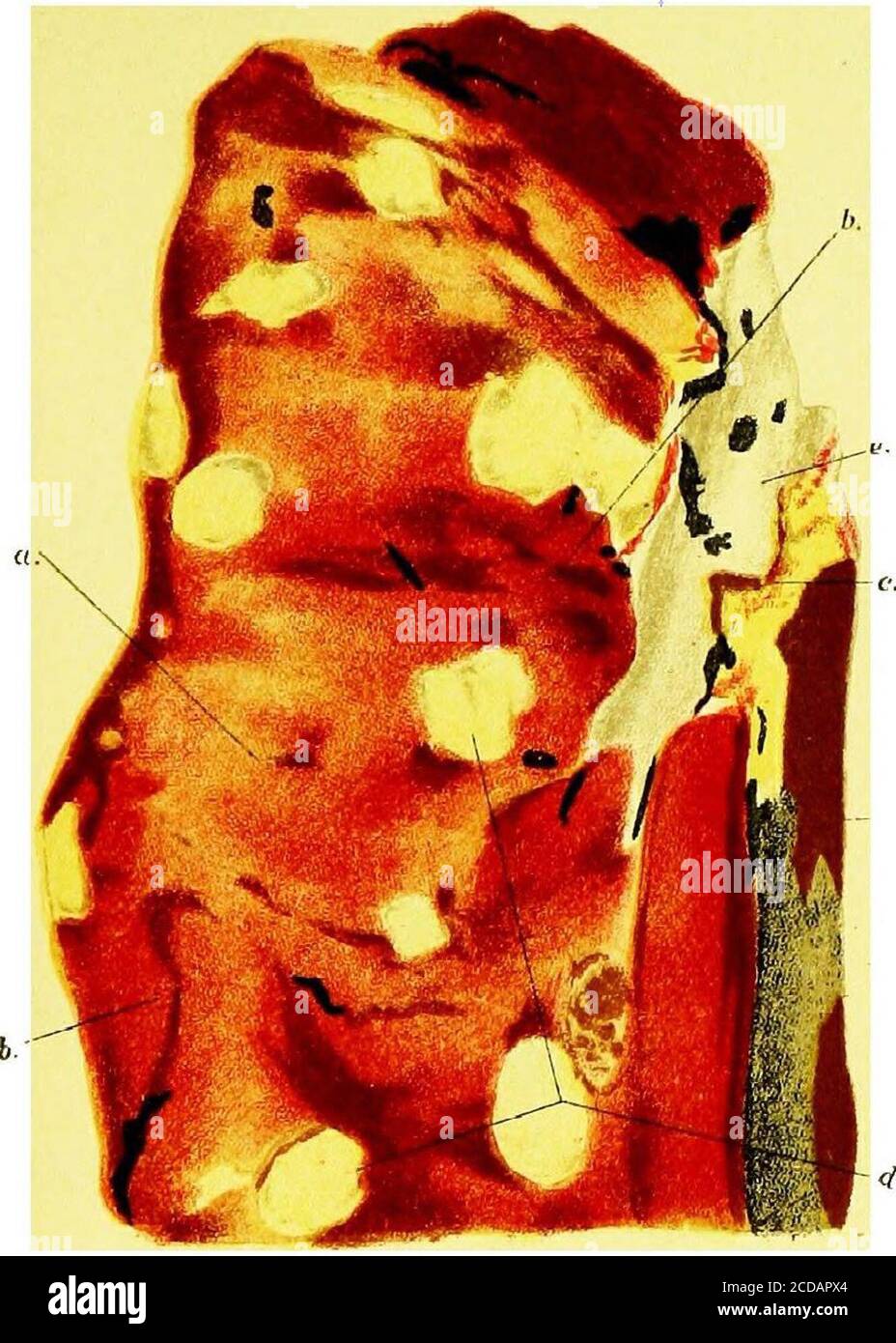 Liver cyst Cut Out Stock Images & Pictures - Alamy