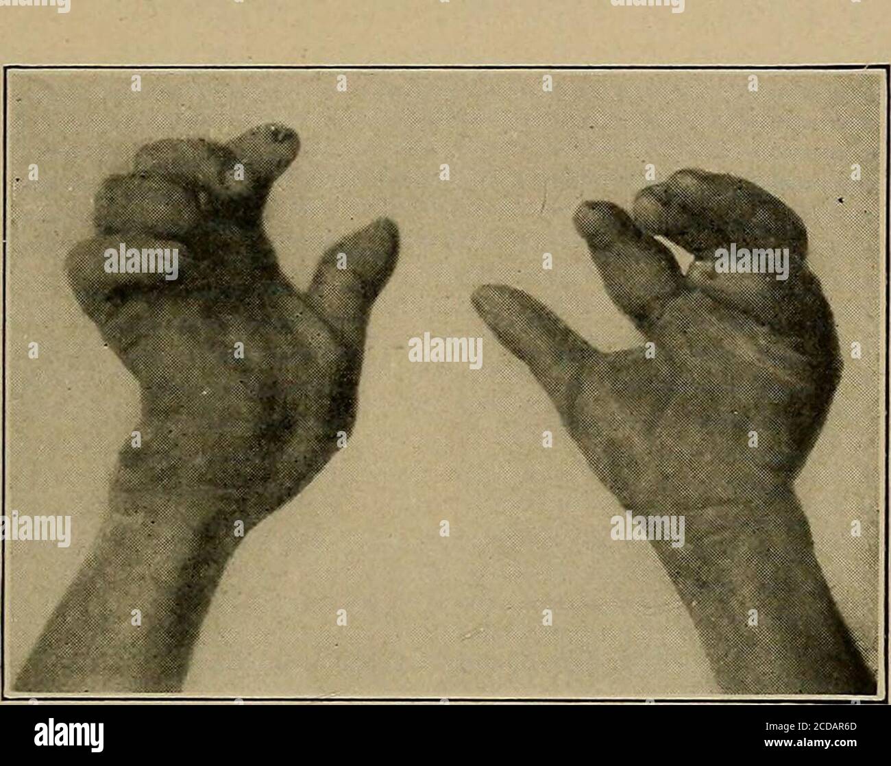 . Physical diagnosis . Fig. 55.—Tuberculous Dactylitis. presents its ...