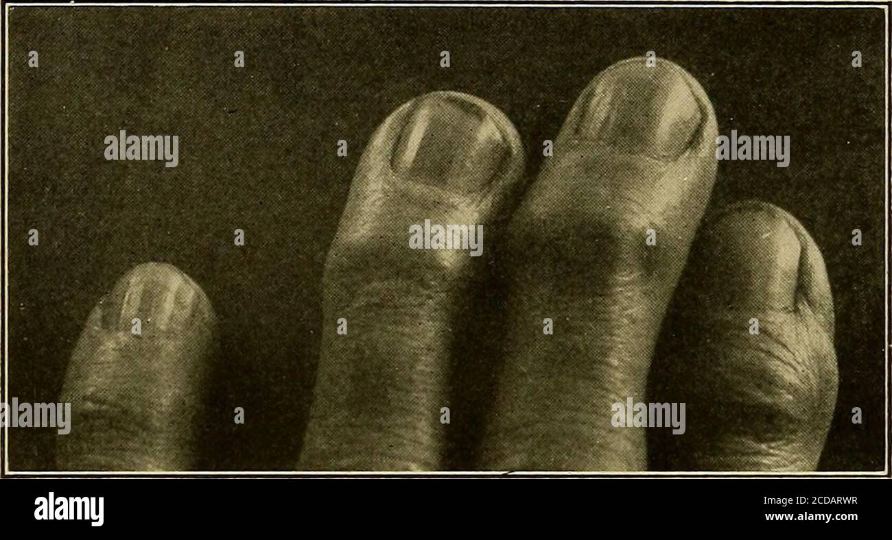 Clubbed fingers hi-res stock photography and images - Alamy