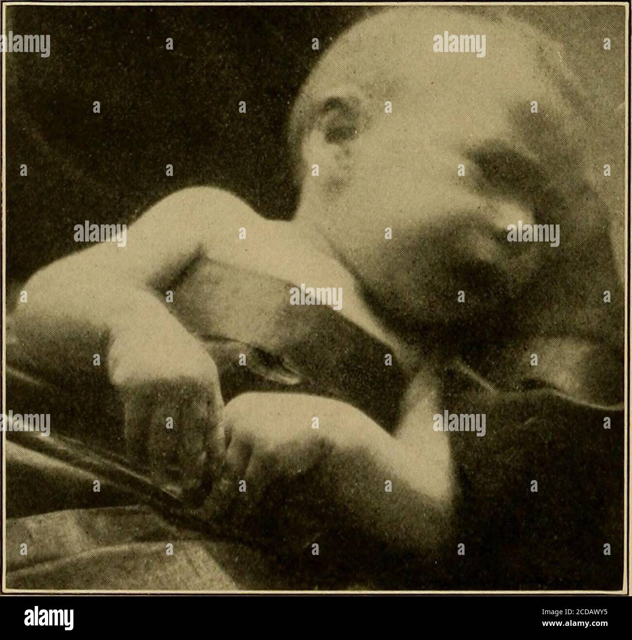 . Physical diagnosis . Fig. 44.—Tetany. (Masland.). Fig. 45.—Tetany ...