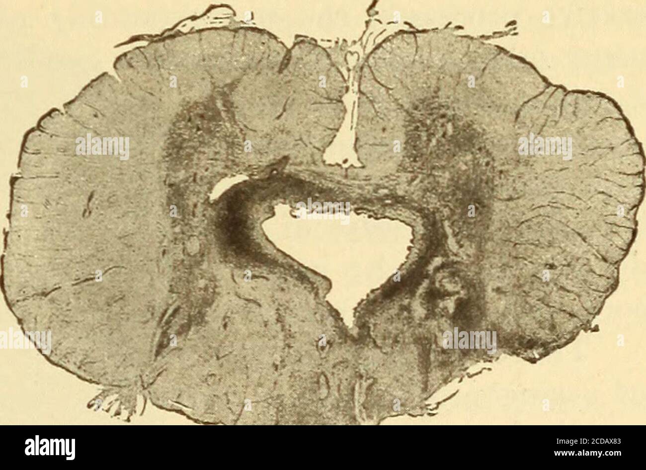 Syringomyelia Cross Section