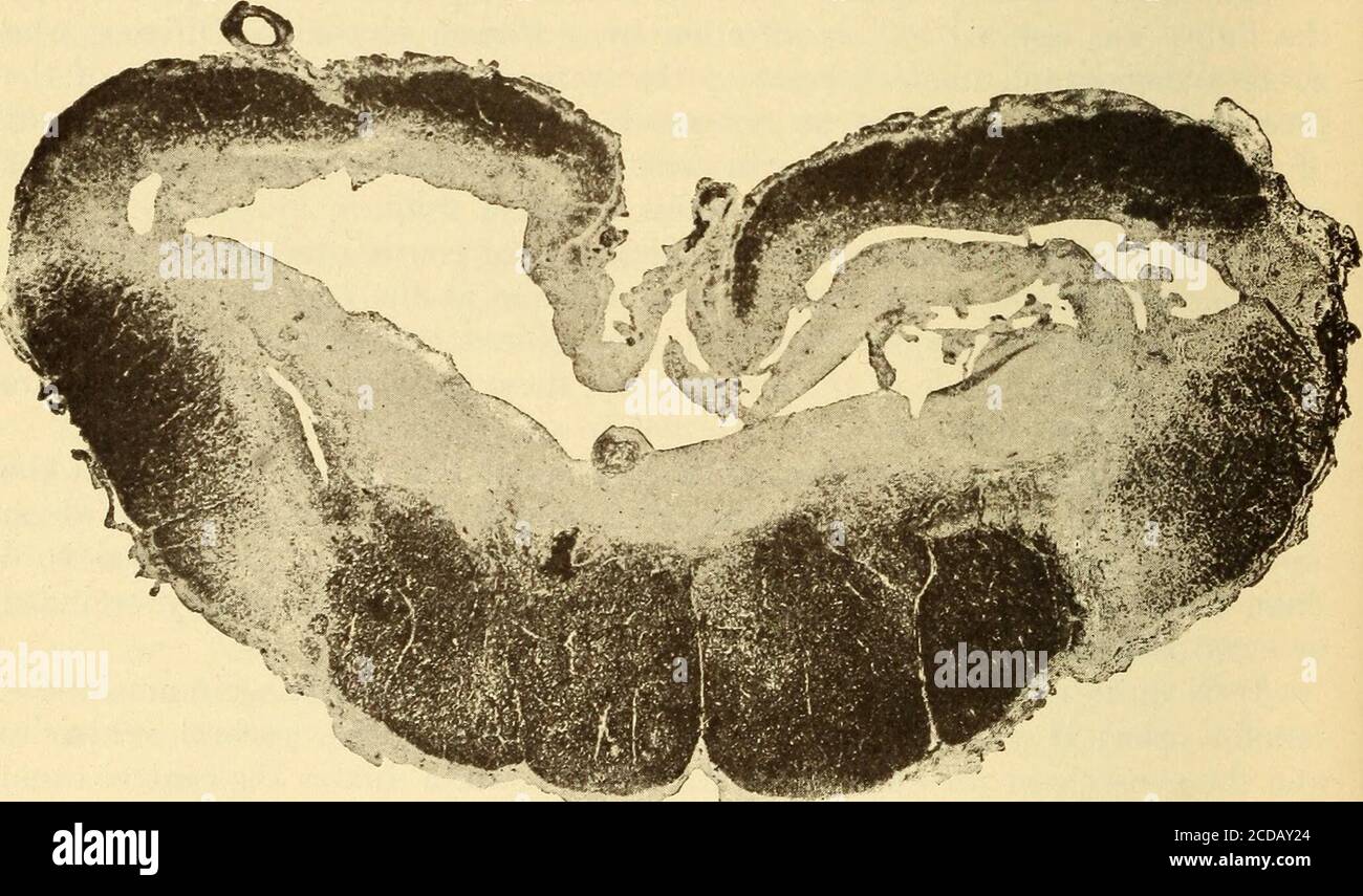 Gliosis hi-res stock photography and images - Alamy