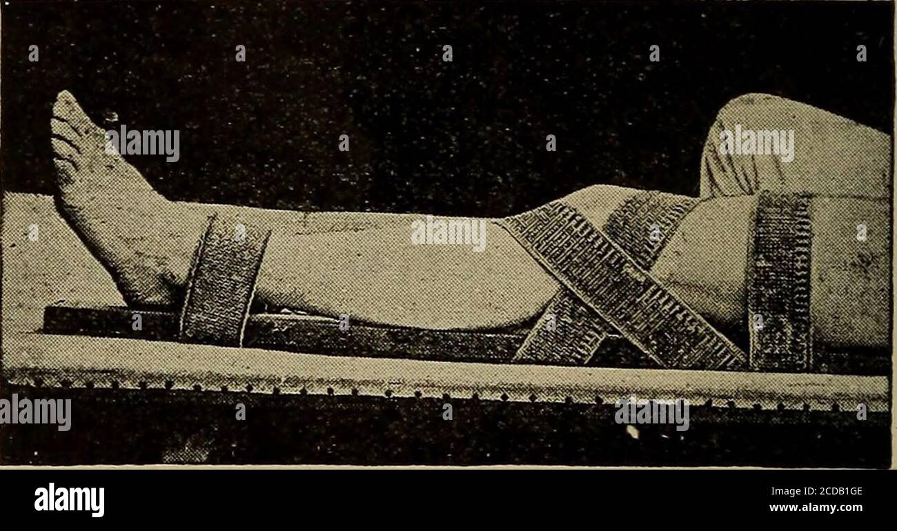 . First aid in illness and injury; . Fig. 127. — Separation of ...