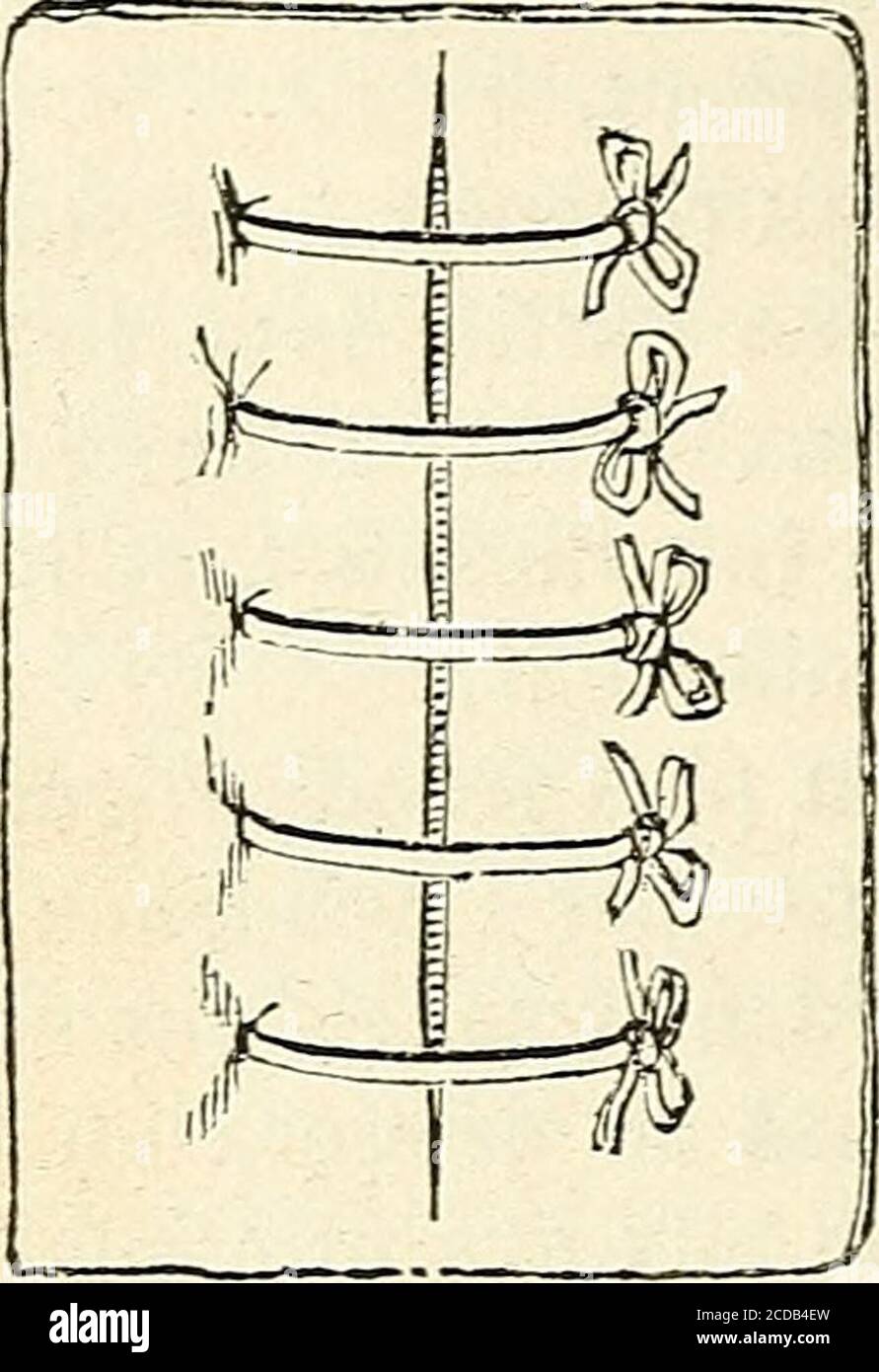 Points de suture chirurgie hi-res stock photography and images - Alamy