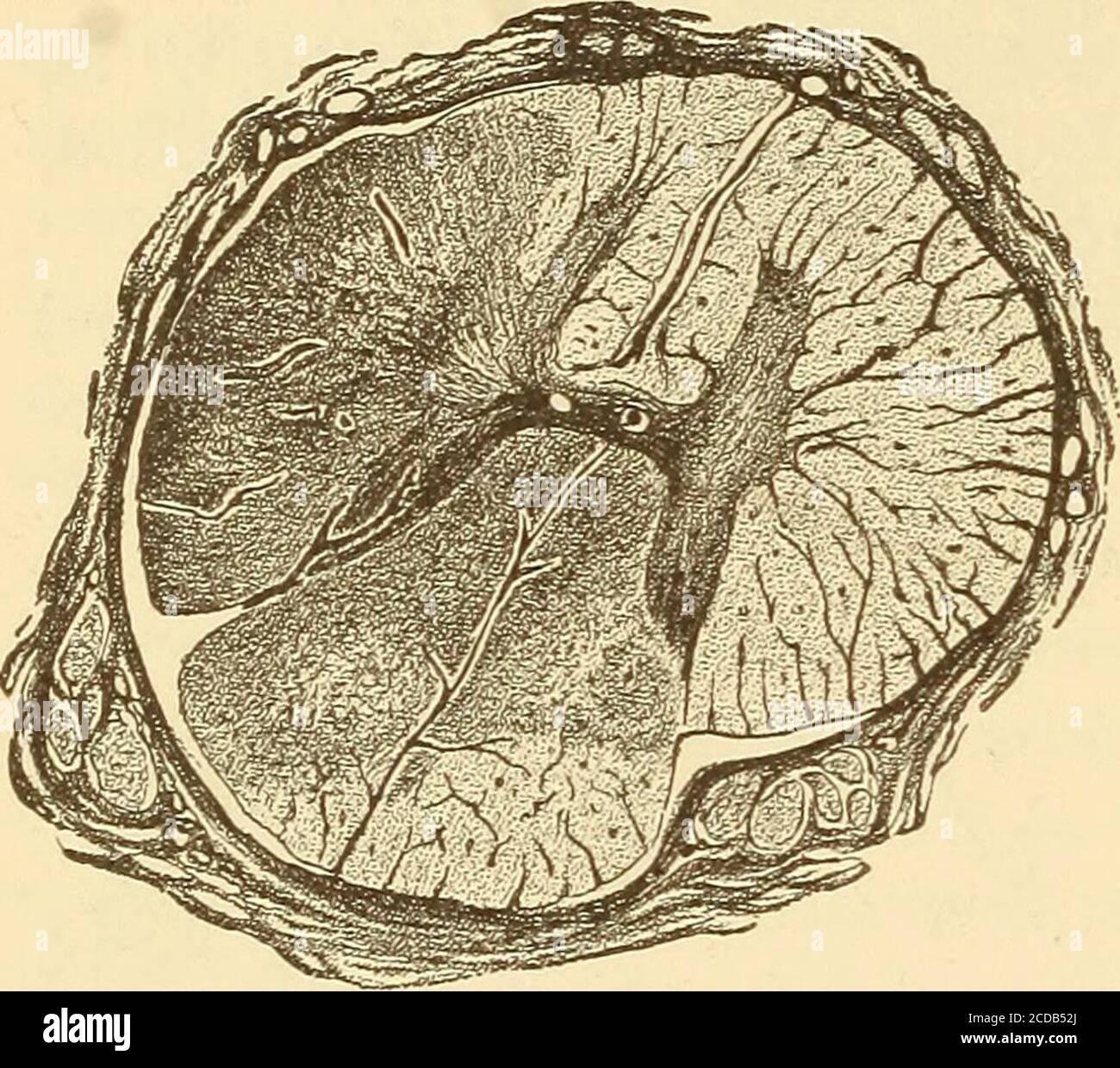 . Diseases of the nervous system . with thoracic girdle sensation,and ...