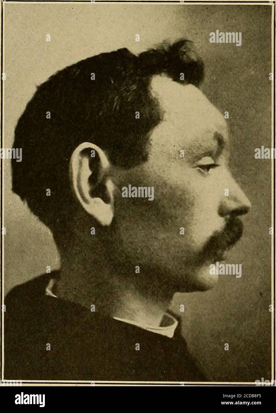 . Physical diagnosis . Fig. 8.—Typical Face in Acromegaly Stock Photo ...