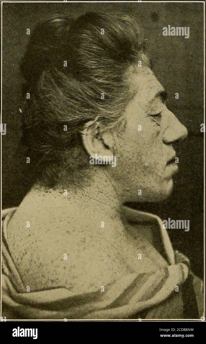 . Physical diagnosis . Fig 7.—Gumma Involving Frontal Bone. 10 PHYSICAL ...