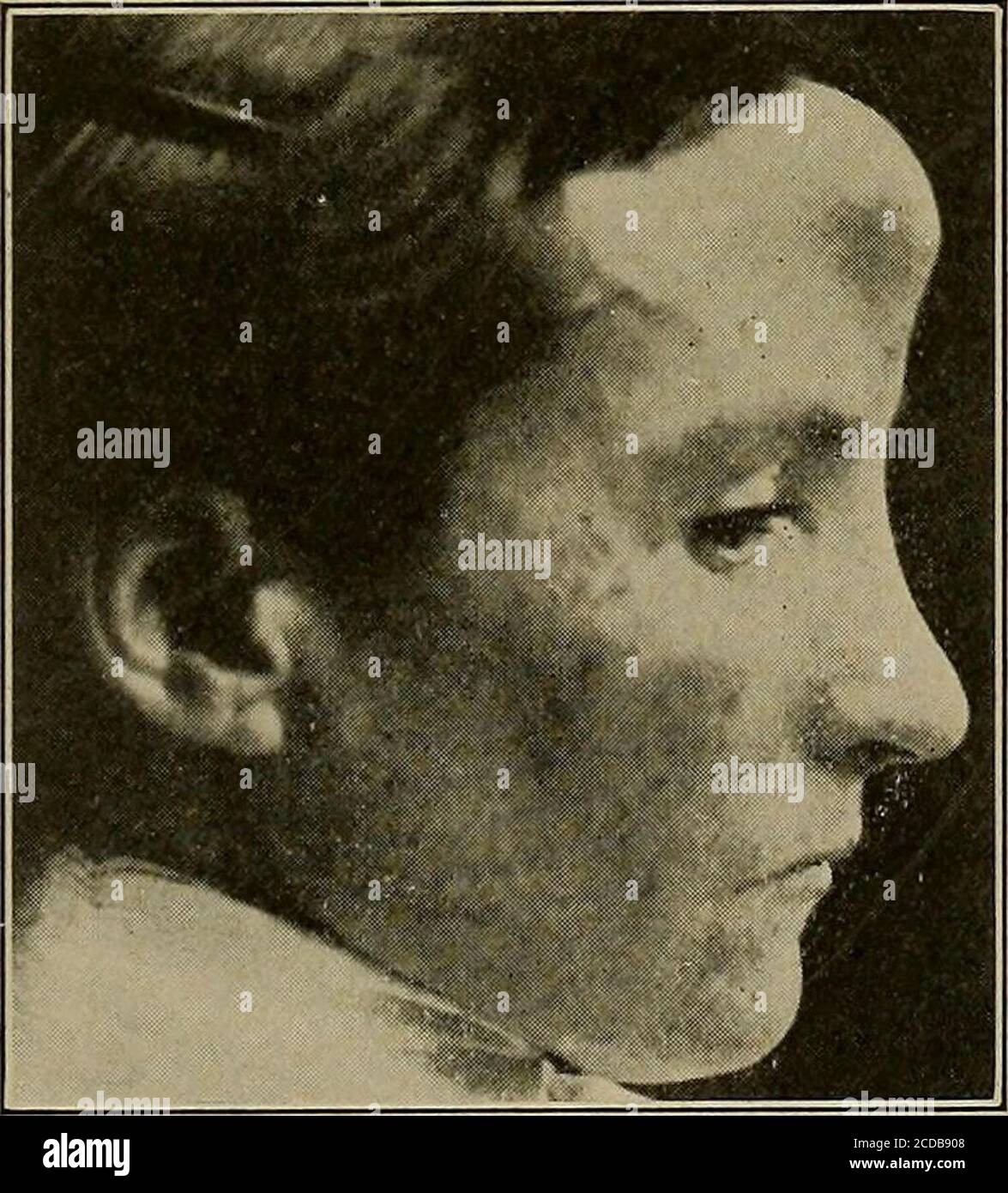 Acromegalia hi-res stock photography and images - Alamy