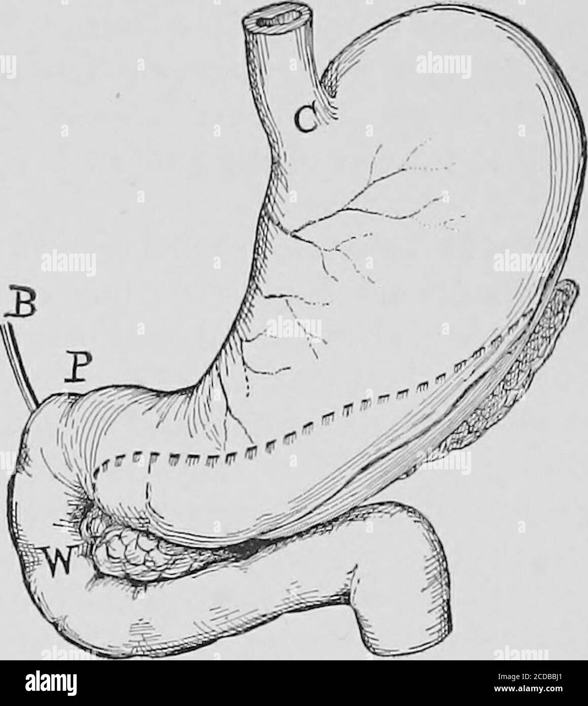 Jejunum tube hi-res stock photography and images - Alamy
