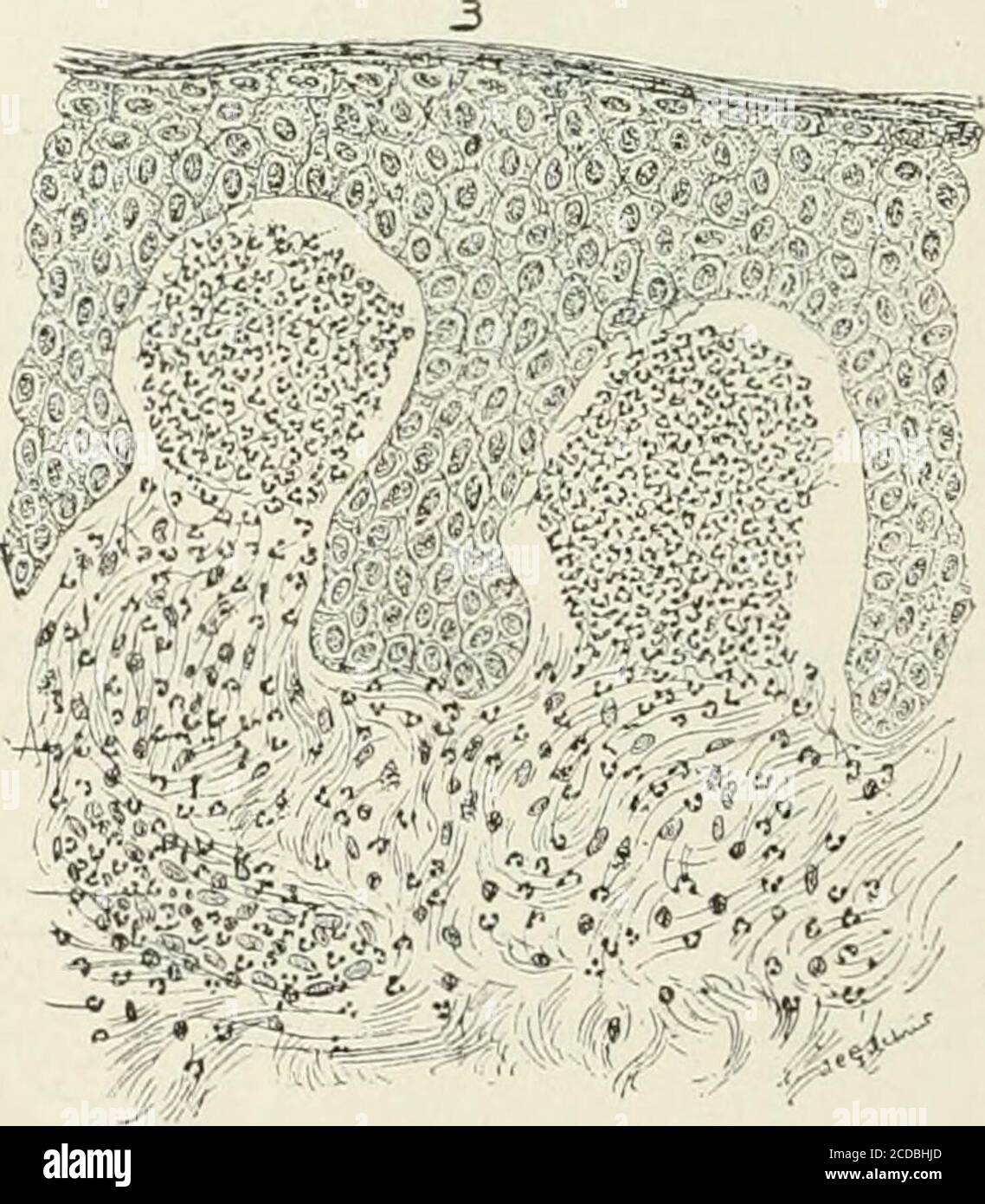 Erythema multiforme hi-res stock photography and images - Alamy