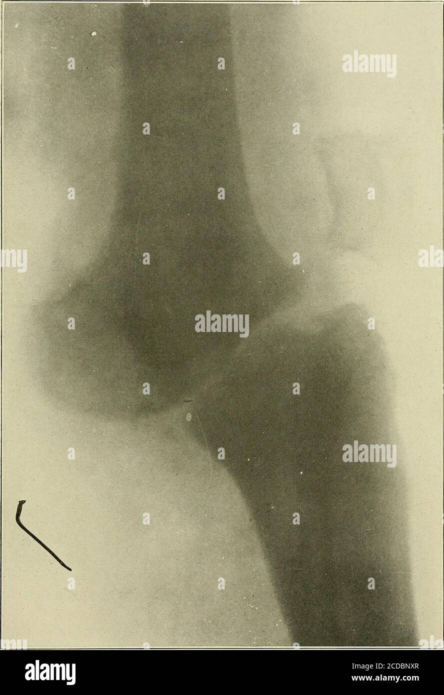 Charcot Joint Syphilis