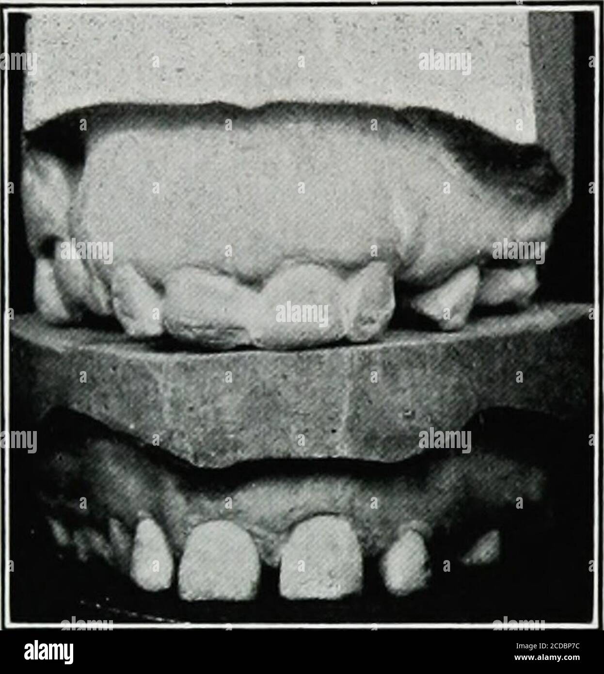 Periodontal pockets hi-res stock photography and images - Alamy