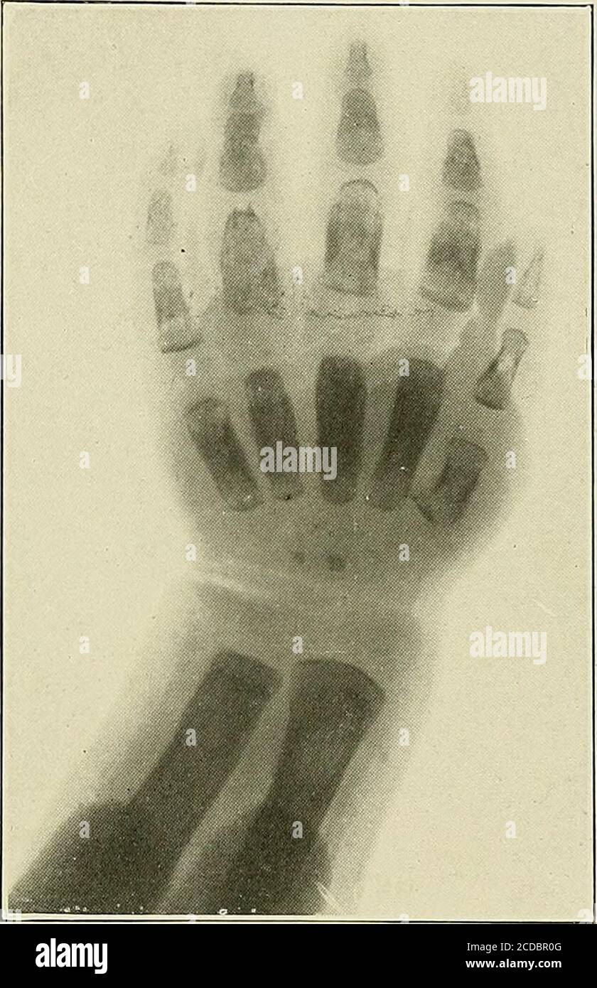 . Syphilis : a treatise on etiology, pathology, diagnosis, prognosis ...