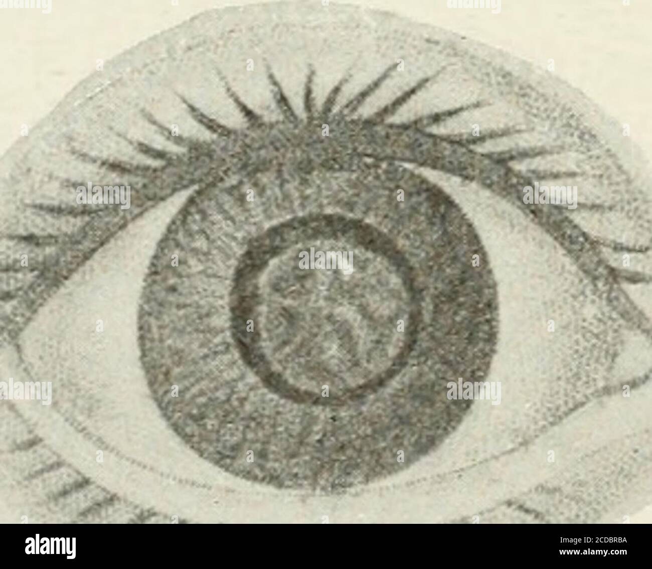 Cataract cortical hi-res stock photography and images - Alamy