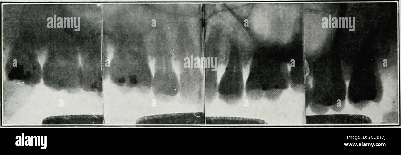 Maxillary radiographs hi-res stock photography and images - Alamy