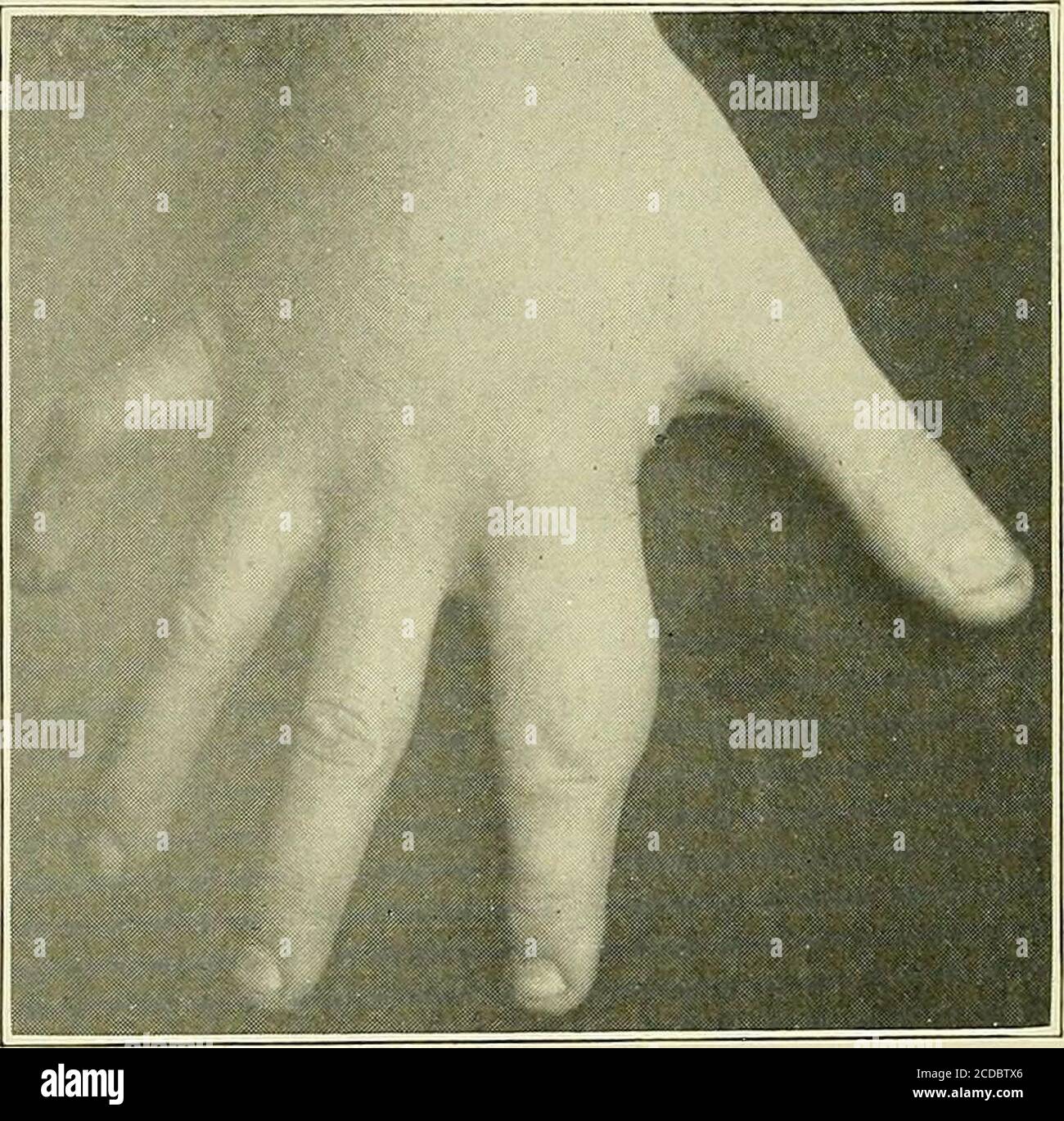 Dactylitis hi-res stock photography and images - Alamy