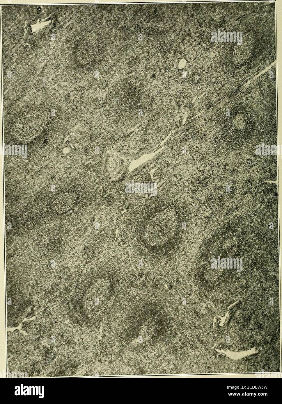 Gummata hi-res stock photography and images - Alamy