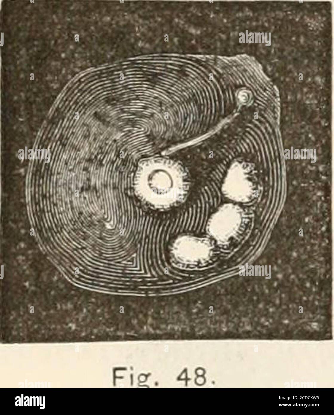 . The pathological anatomy of the ear . Fig. 46. Fig. 47. Fig. 46 ...