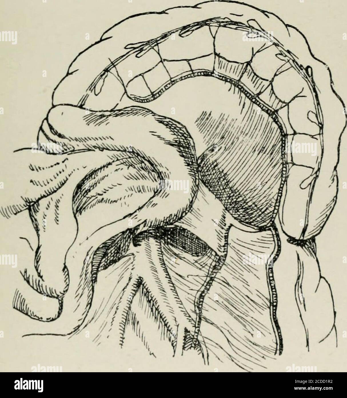 . On retro-peritoneal hernia . ng limb of the duodenum, and I am ...