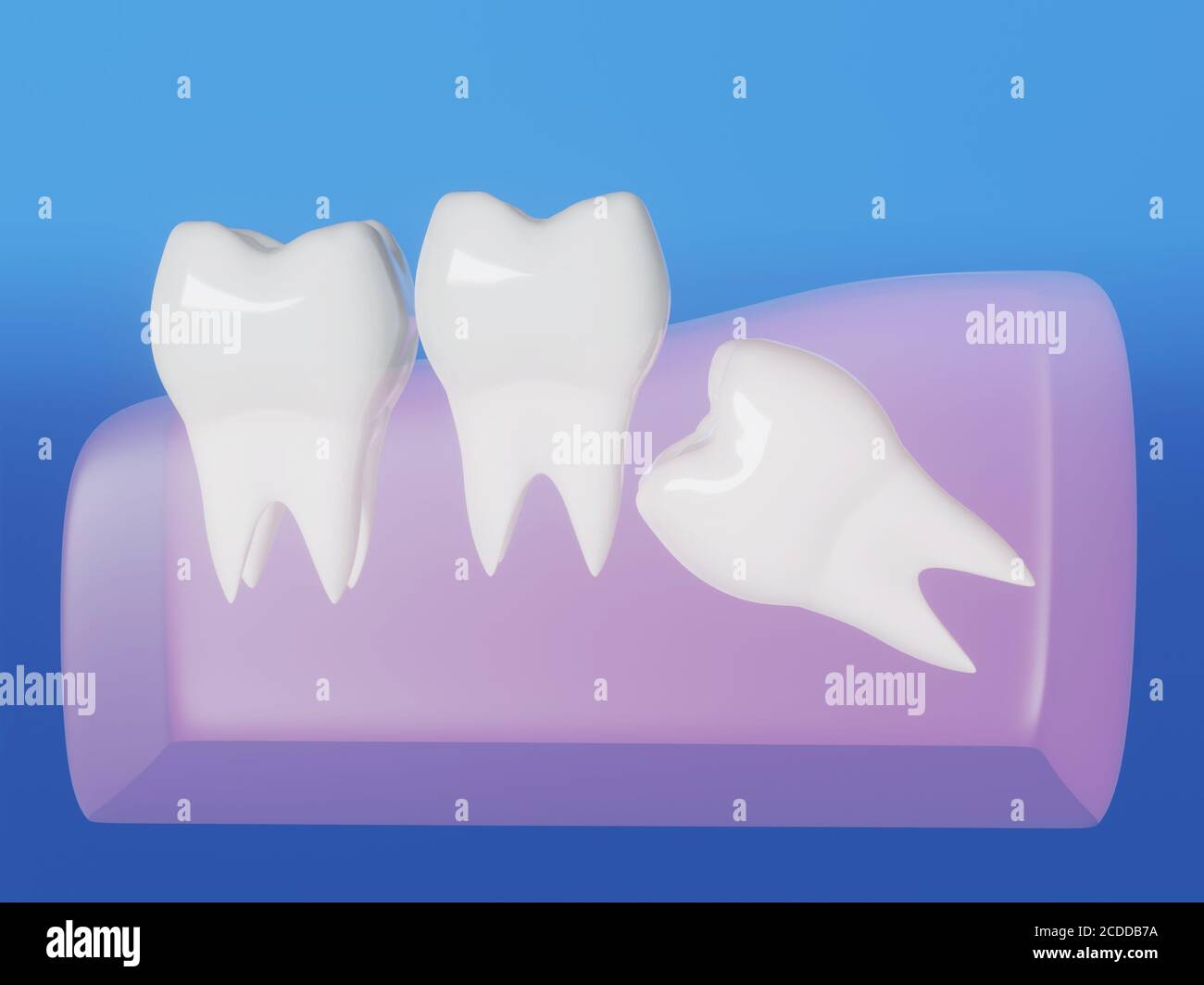 Wisdom tooth grows wrong, wisdom tooth problem, horizontal position of ...