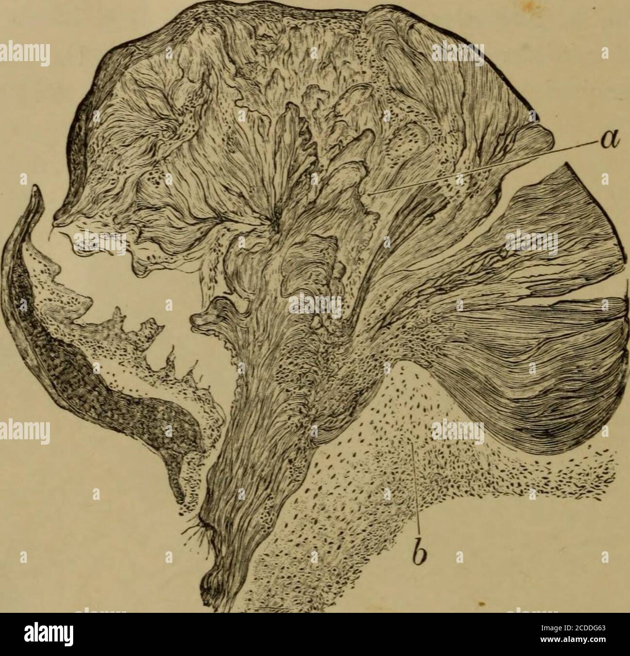 Endarteritis hi-res stock photography and images - Alamy