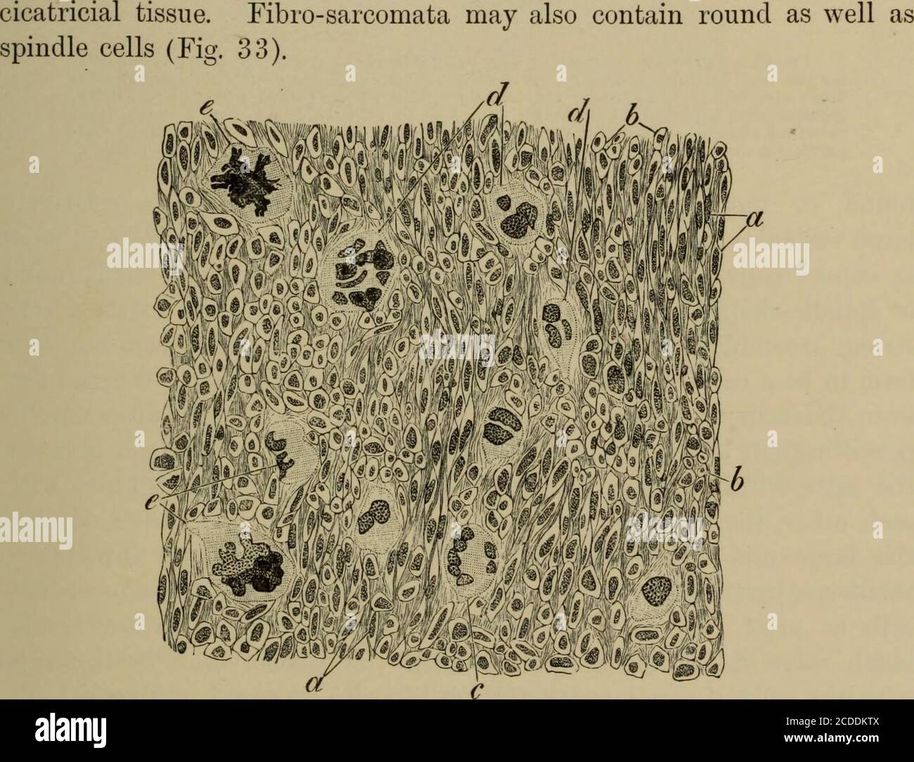 Sarcomatous tissue hi-res stock photography and images - Alamy