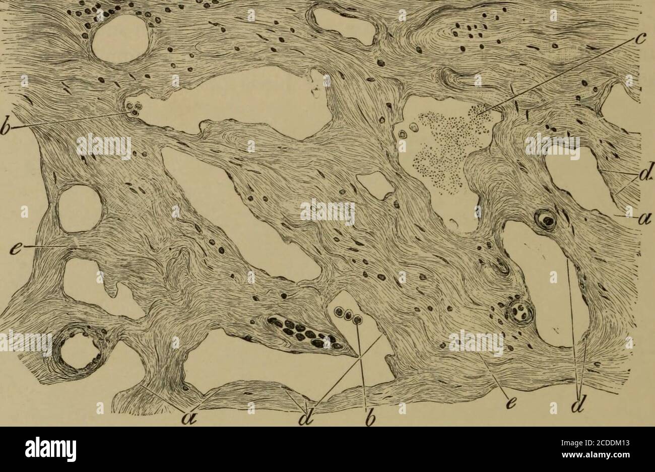 Lymphangioma hi-res stock photography and images - Alamy