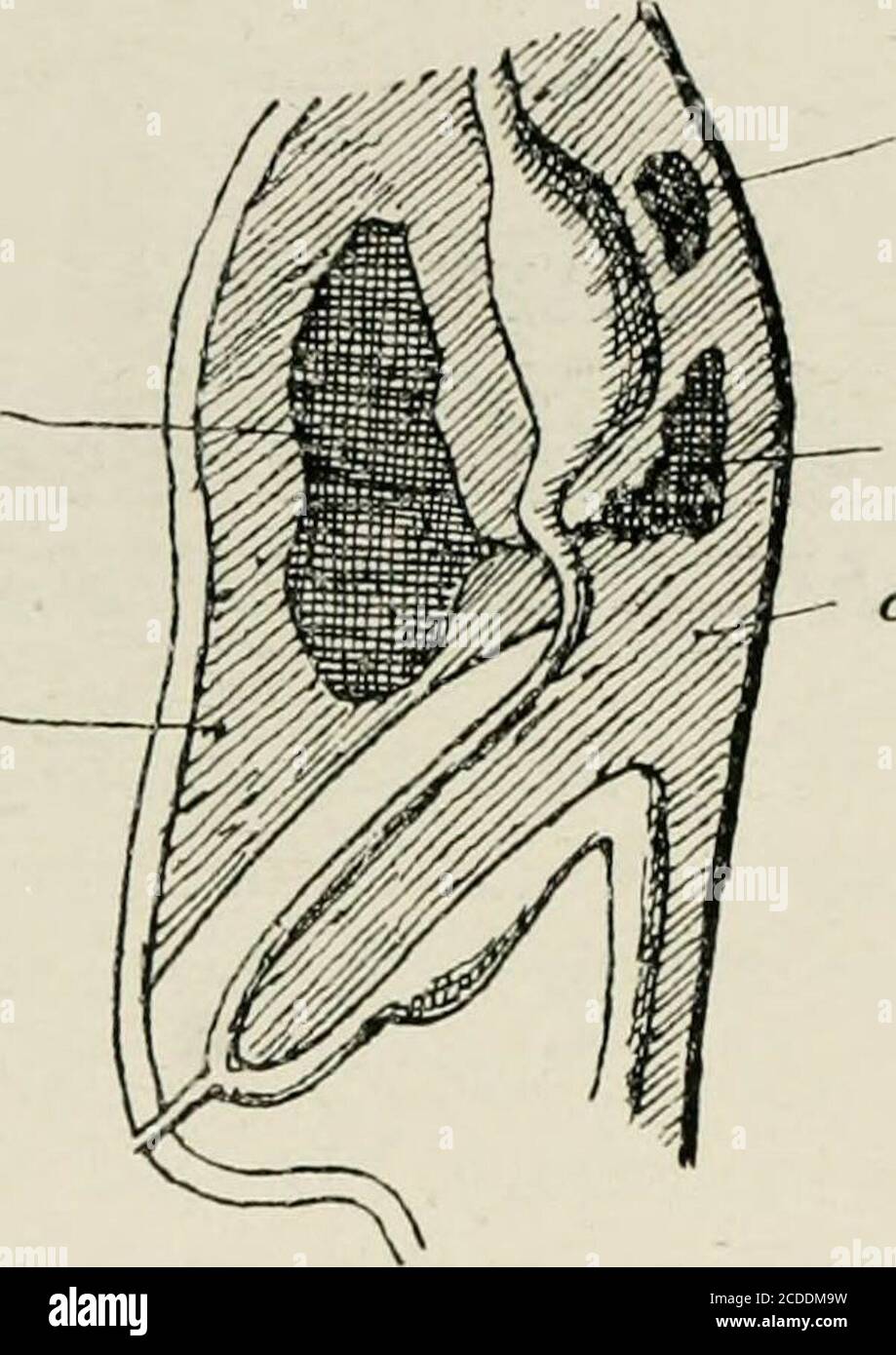 Tail of pancreas hi-res stock photography and images - Alamy