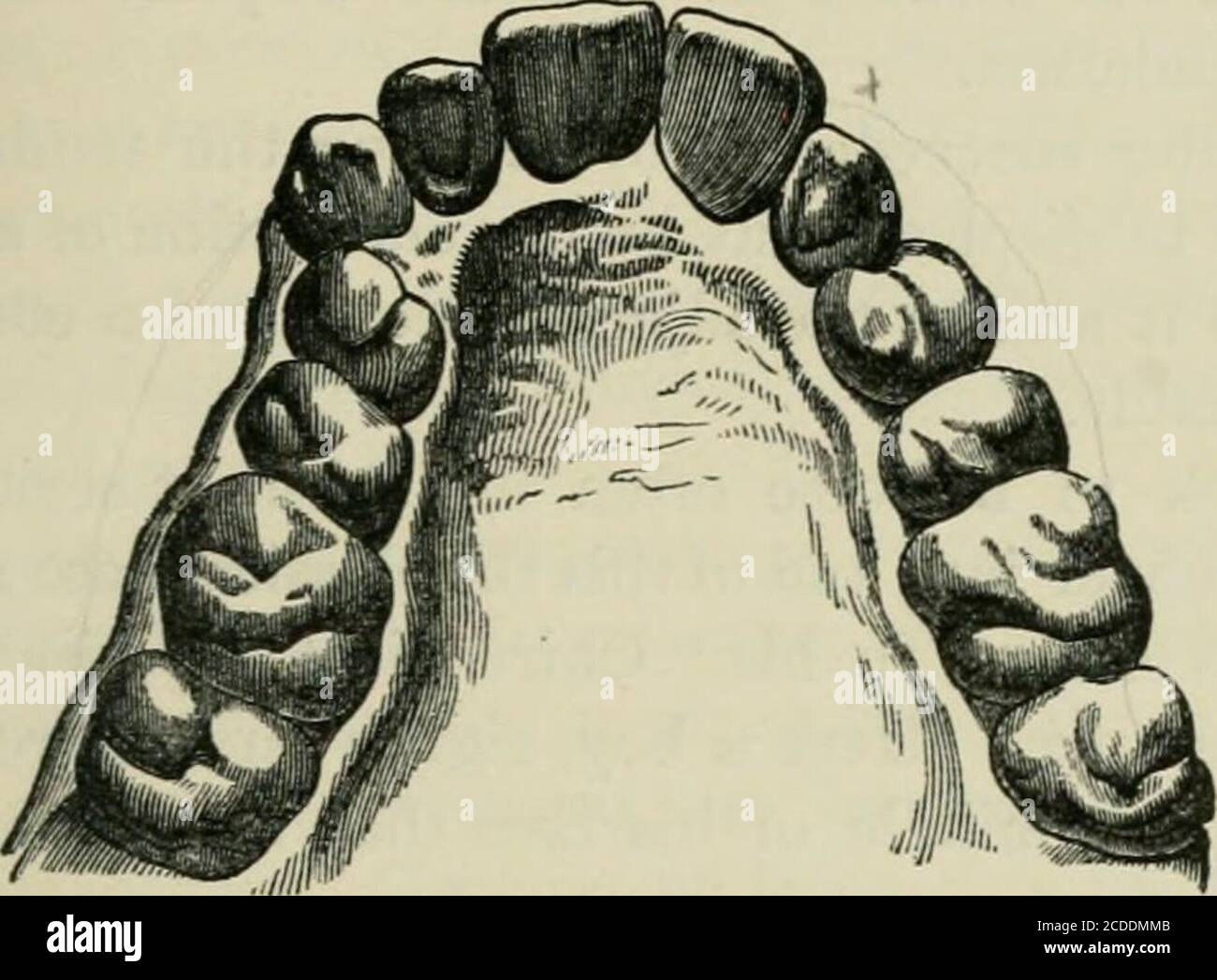 Compound Bone Fracture High Resolution Stock Photography and Images - Alamy