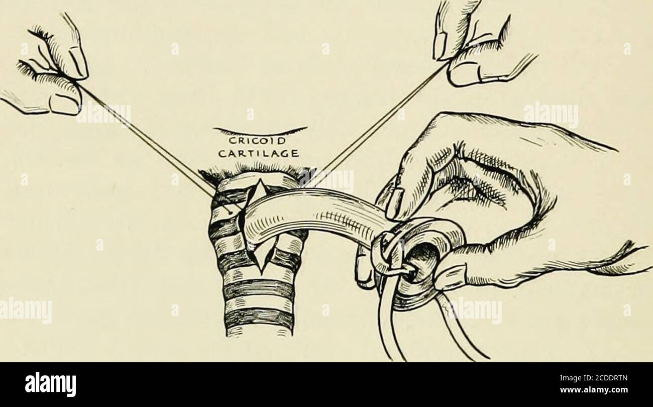 Trachea With Mucus High Resolution Stock Photography and Images - Alamy