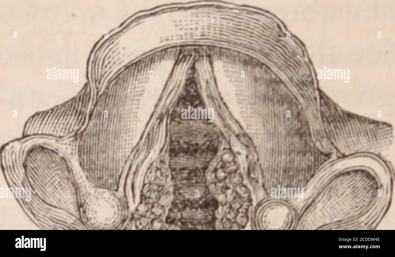 Tertiary syphilis hi-res stock photography and images - Alamy