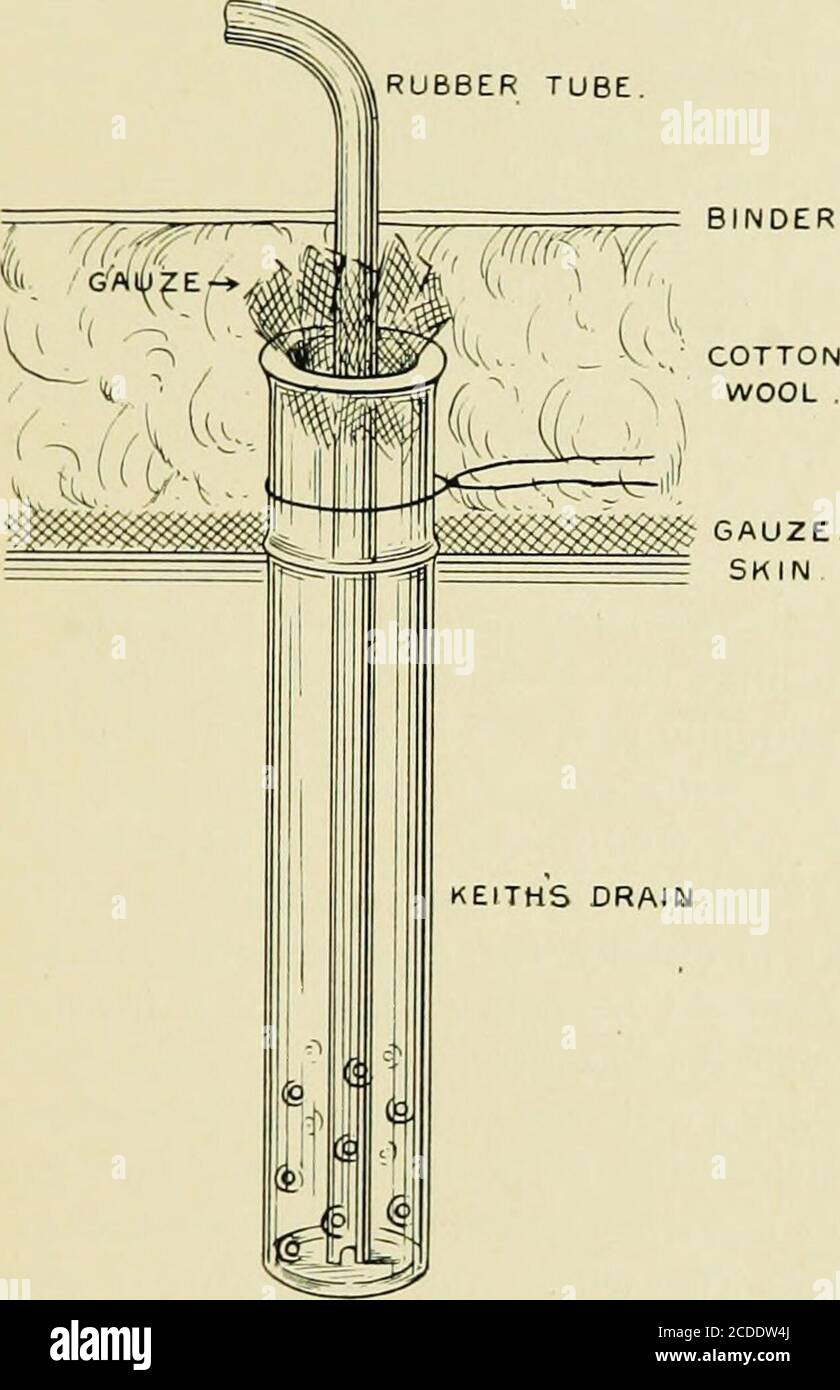 Wound drainage hi-res stock photography and images - Alamy