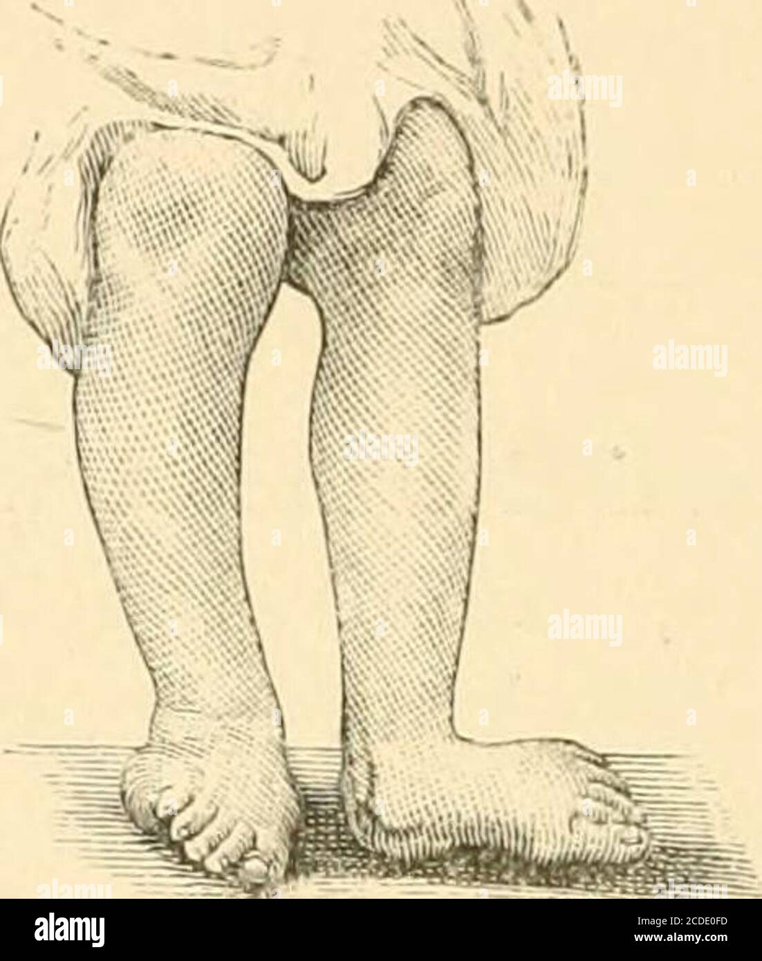 . The surgical treatment of the common deformities of children . e ...