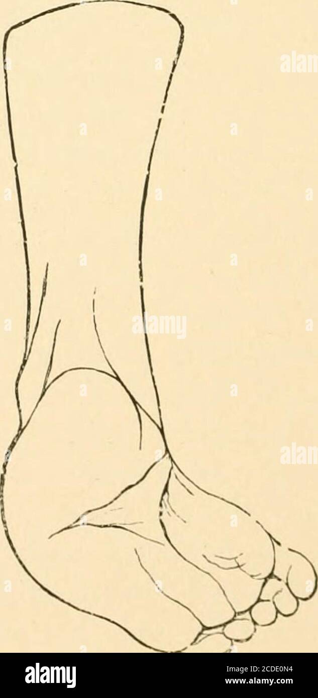. The surgical treatment of the common deformities of children . with ...