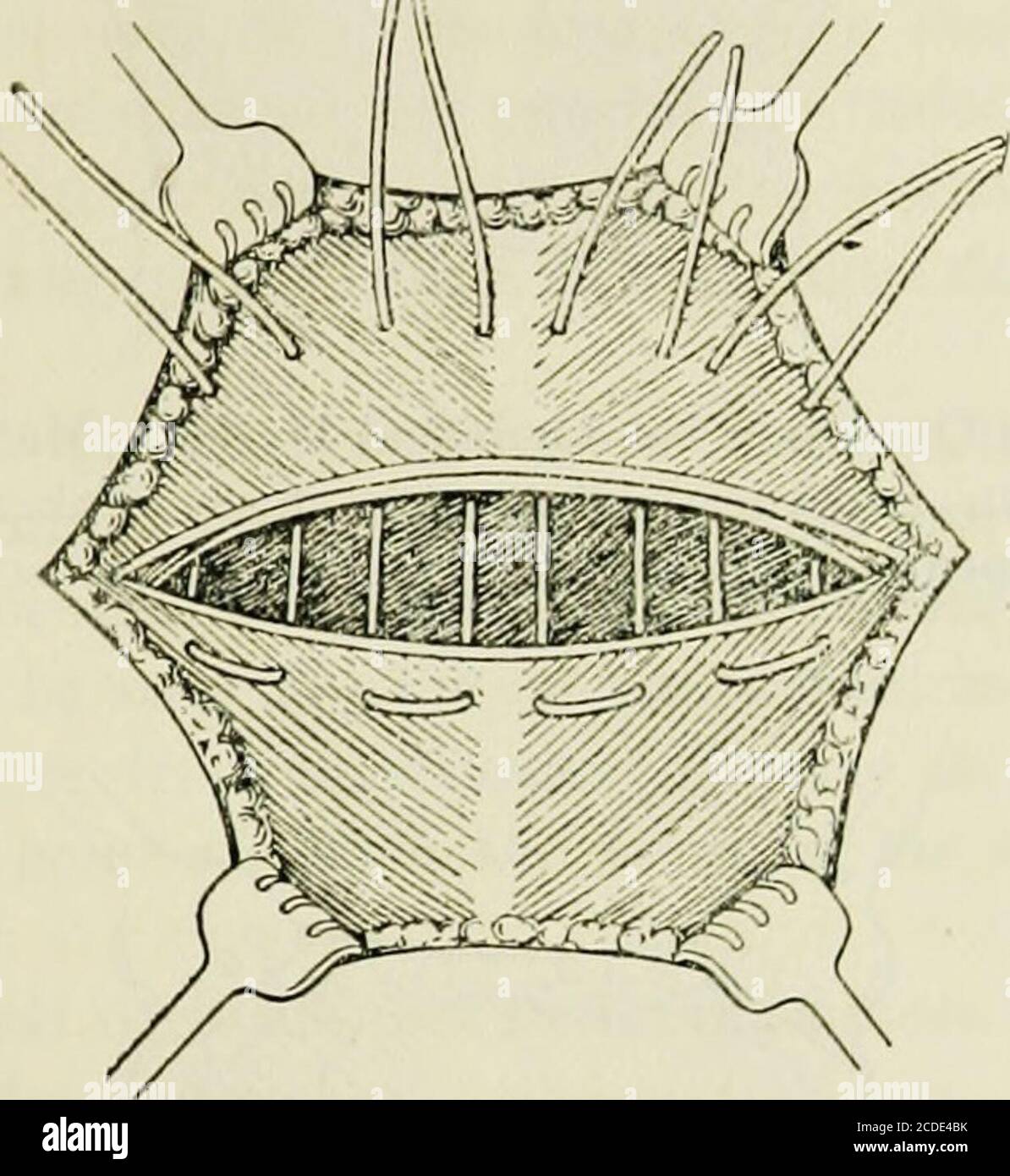 Anterior transposition hi-res stock photography and images - Alamy