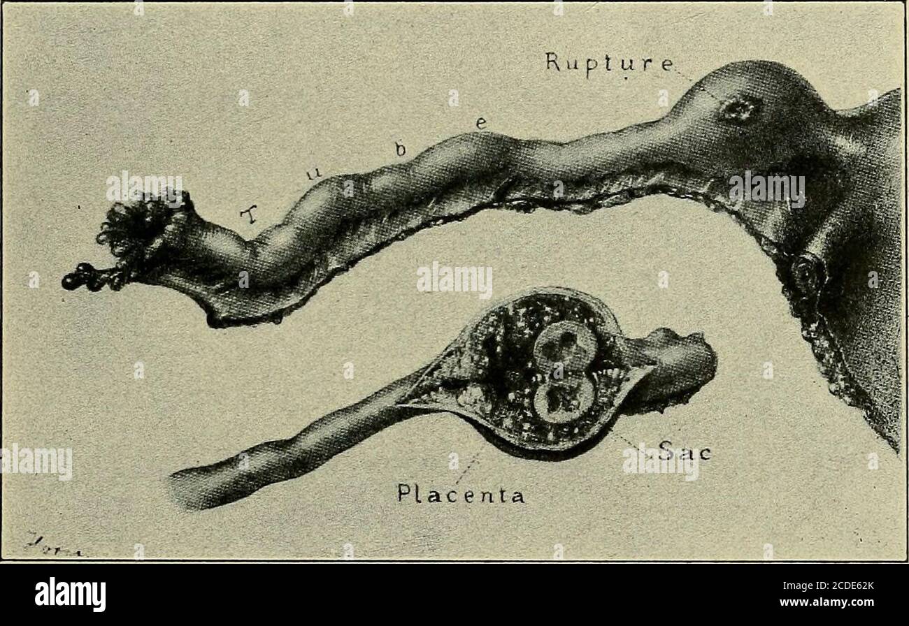 Tubal Pregnancy High Resolution Stock Photography and Images - Alamy