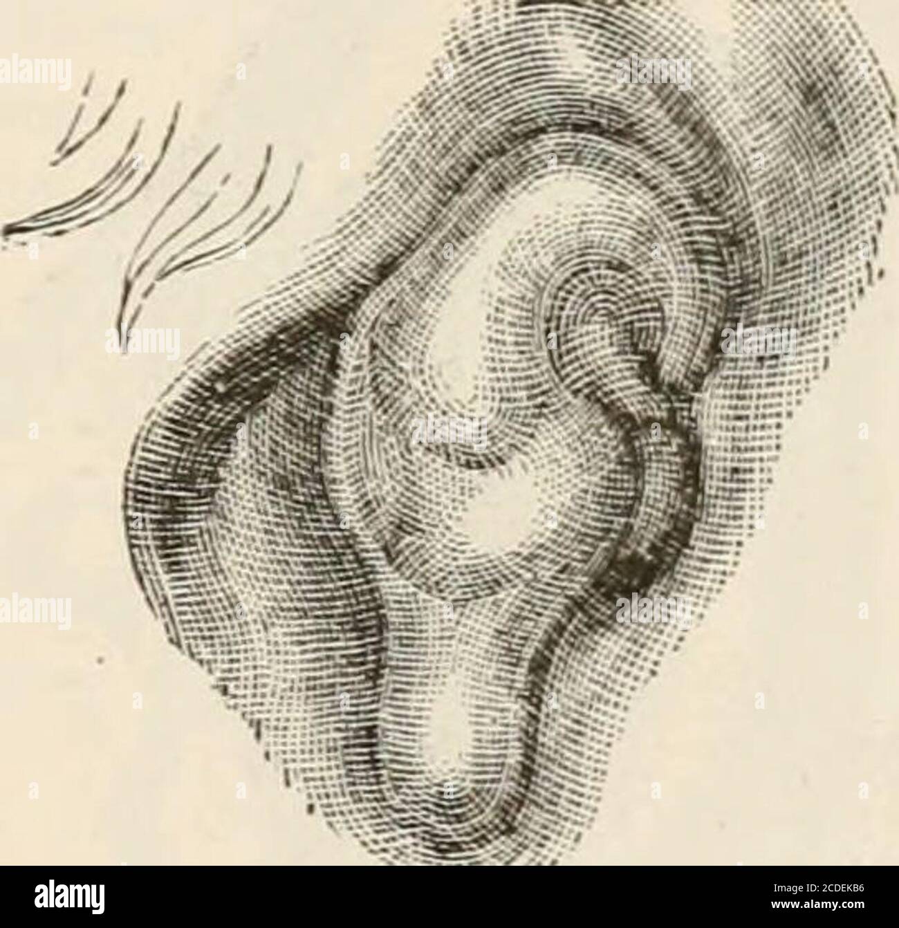 The Pathological Anatomy Of The Ear Fig 21 Congenital Deformity Of The Auriclefrom J