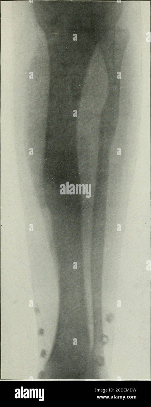 Tibial fracture hi-res stock photography and images - Alamy