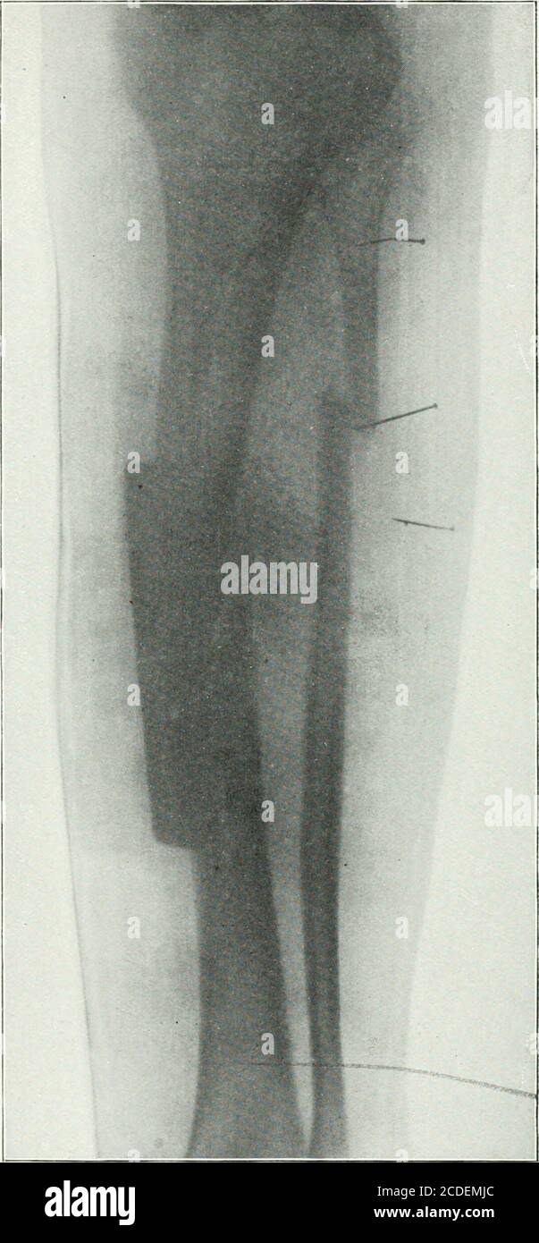 . Annals of surgery . Fig. I.—Showing broken tibia and fibula at ...