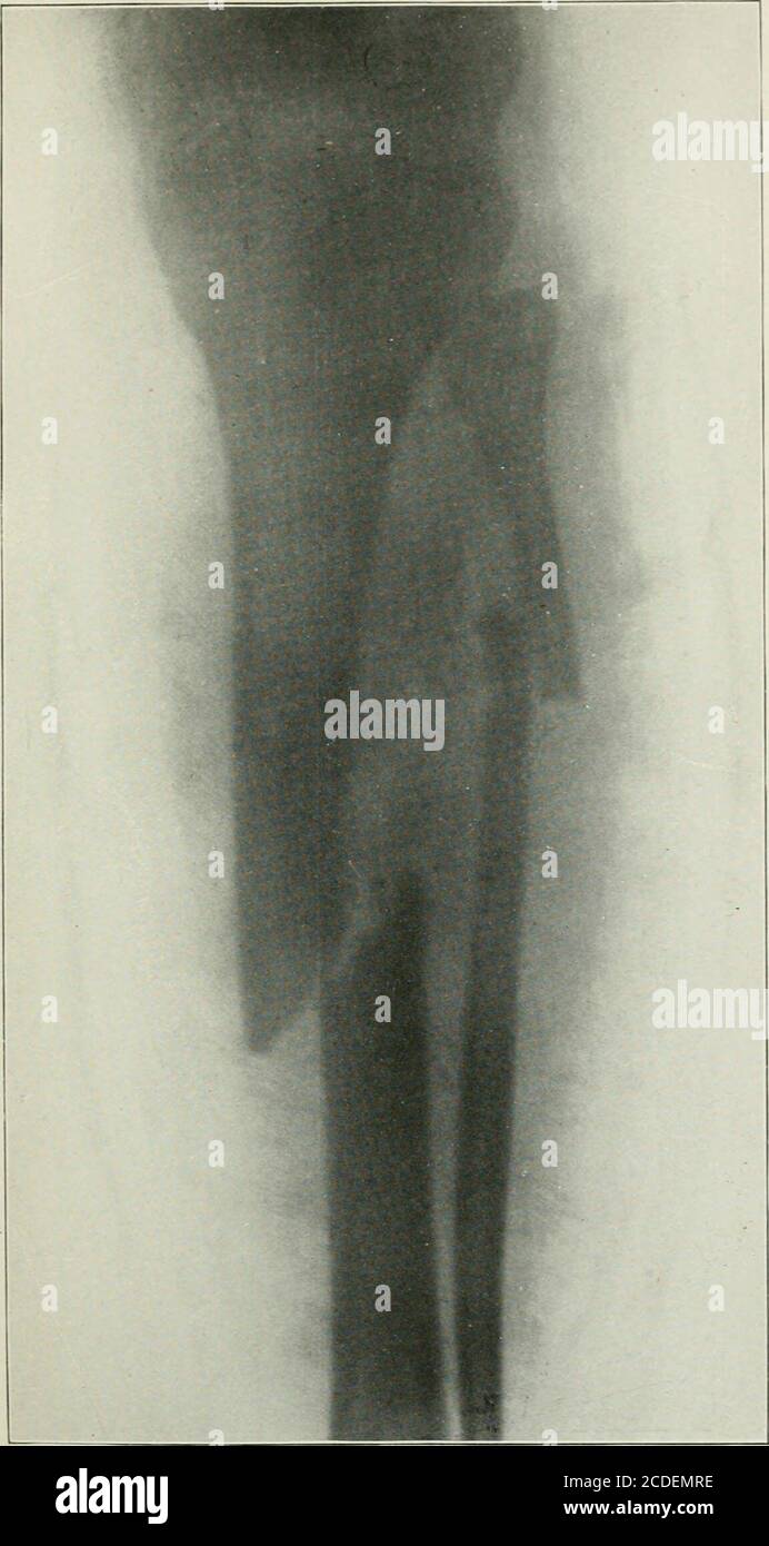 Square bone fragment hi-res stock photography and images - Alamy