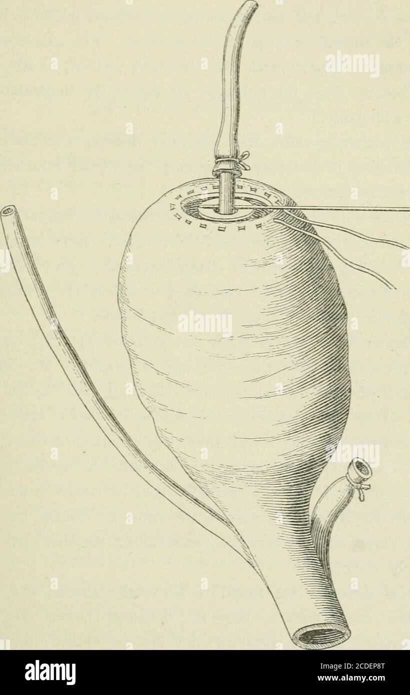 . Annals of surgery . Fig. 3.—Ureter fixed upon the button.(One-half ...