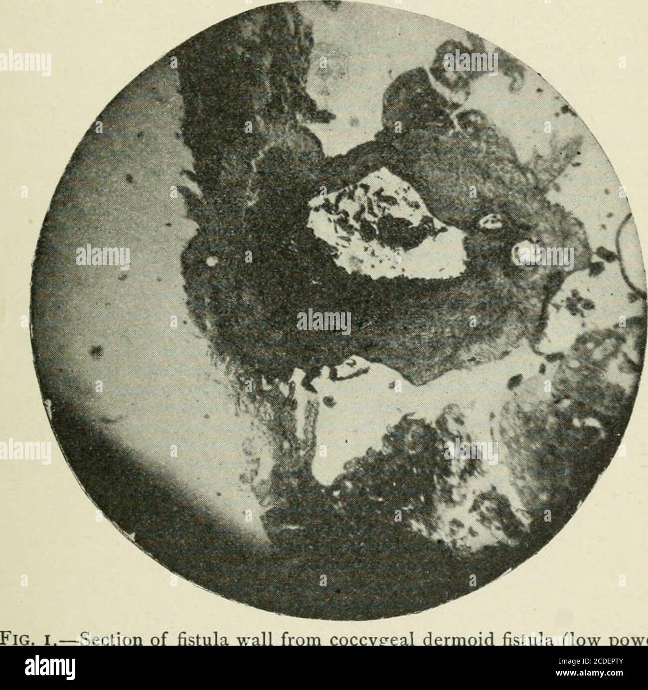Sebaceous cysts hi-res stock photography and images - Alamy
