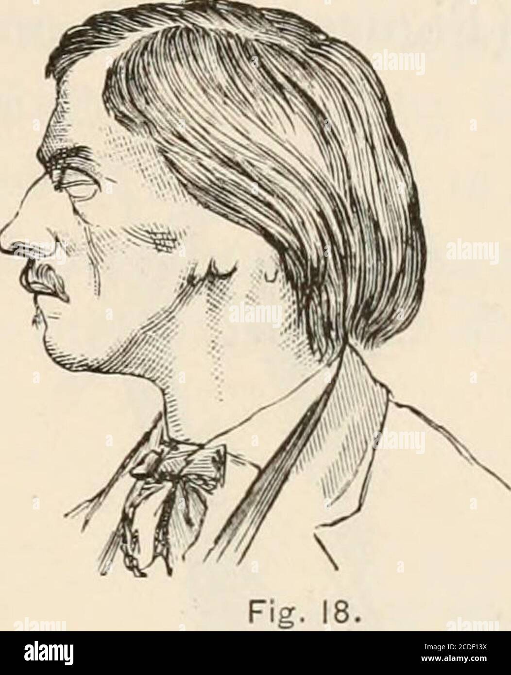 . The pathological anatomy of the ear . Fig. 17. Fig. 17. Unilateral ...