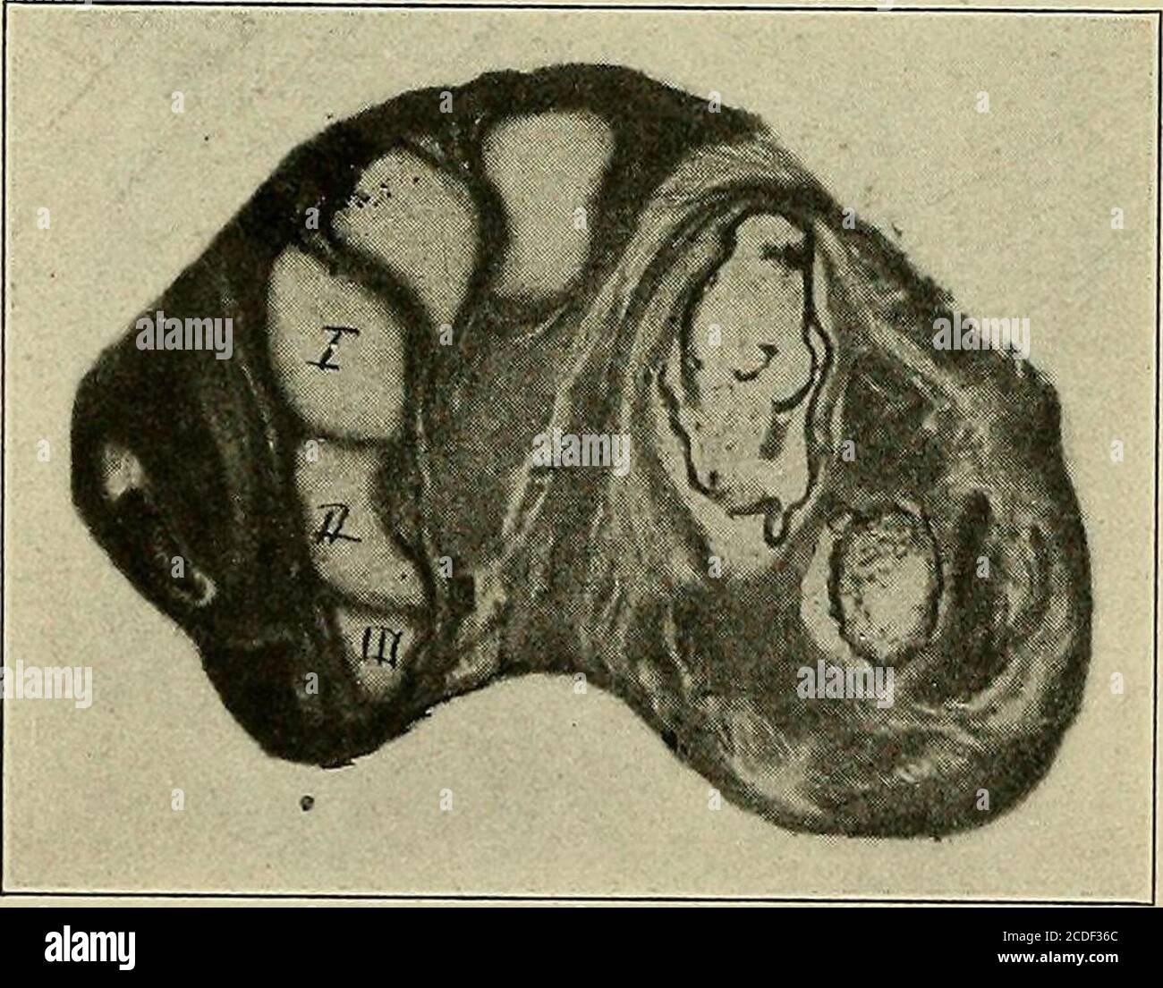 Necrotic hand hi-res stock photography and images - Alamy