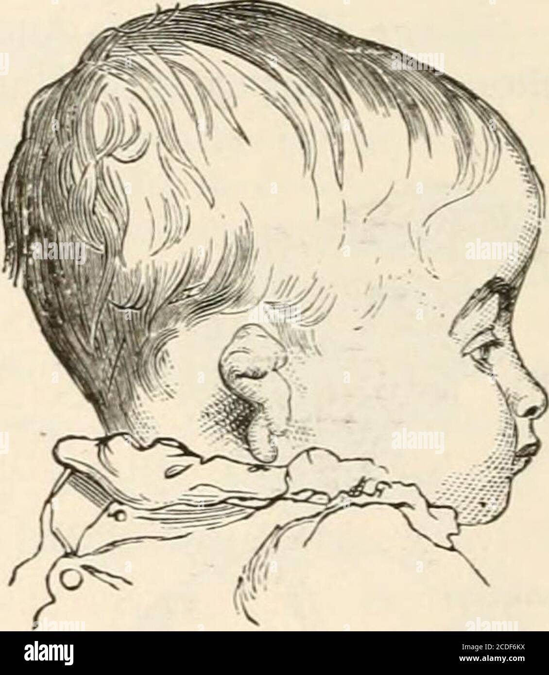 . The pathological anatomy of the ear . Fig. 15. Fig. 16. Cats-ear on ...