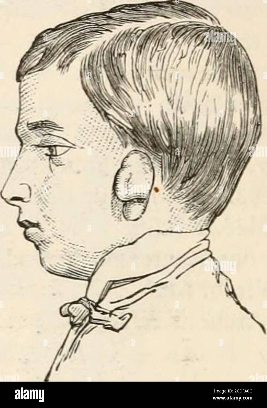 . The pathological anatomy of the ear . Fig. 13. Fig. 14 Stock Photo ...