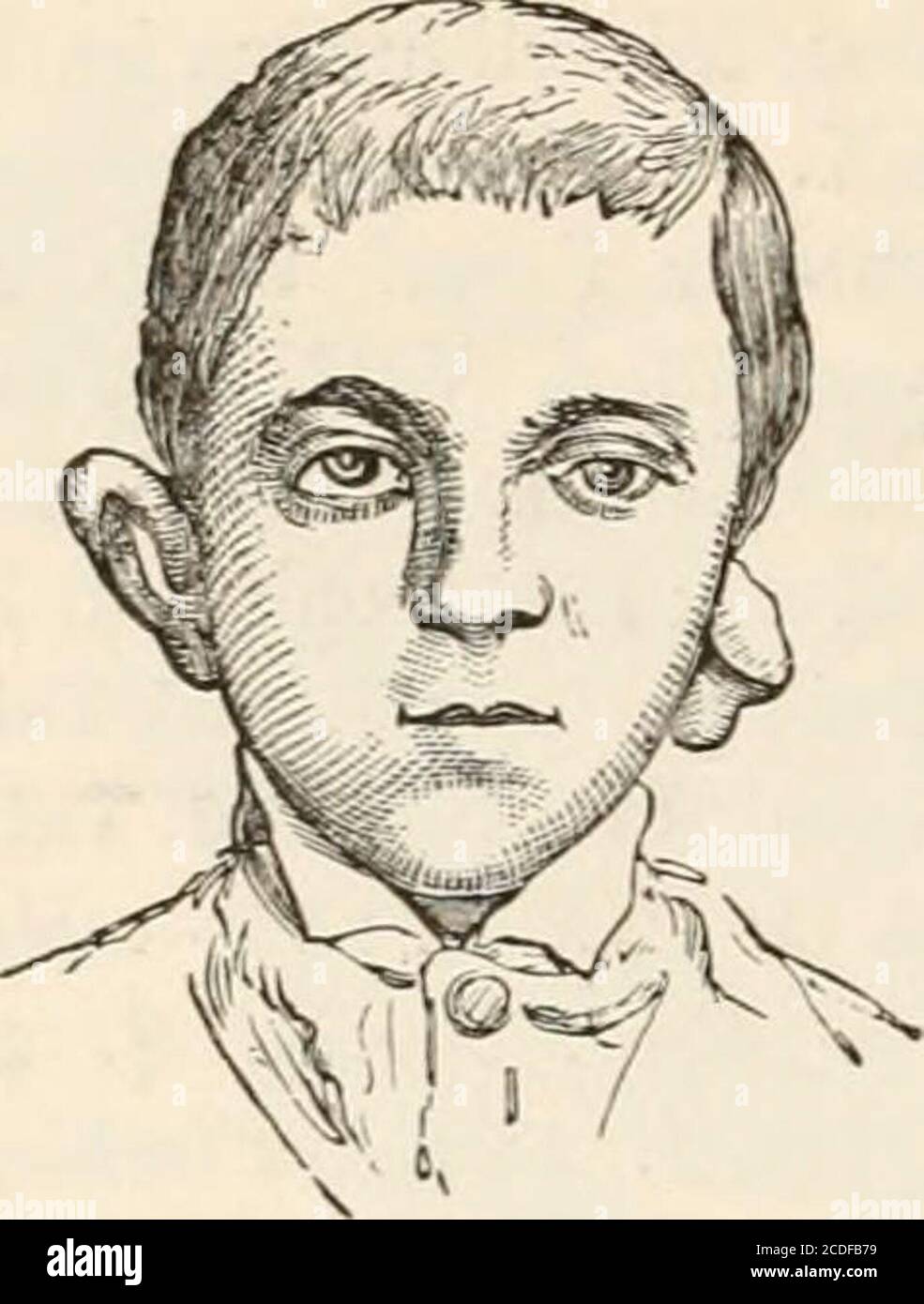. The pathological anatomy of the ear . Fig. II. Fig. 12. Bilateral ...