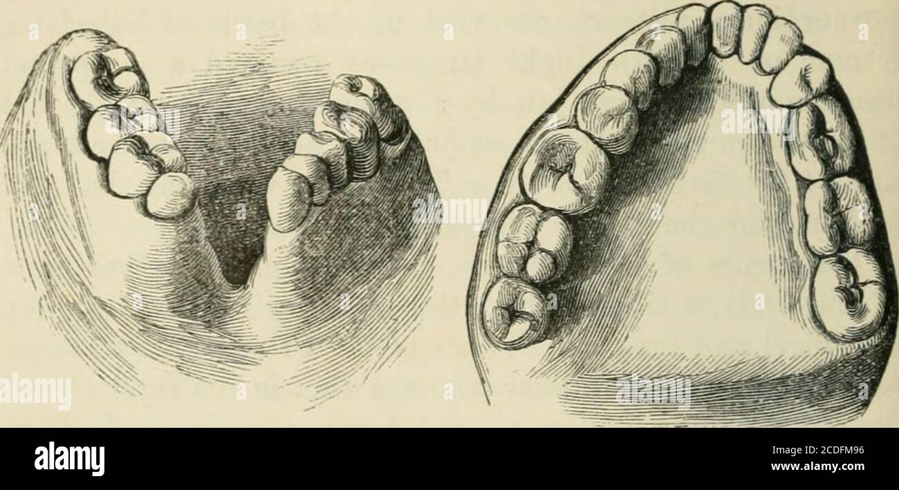 . Injuries and diseases of the jaws . ently removed from beneath the ...